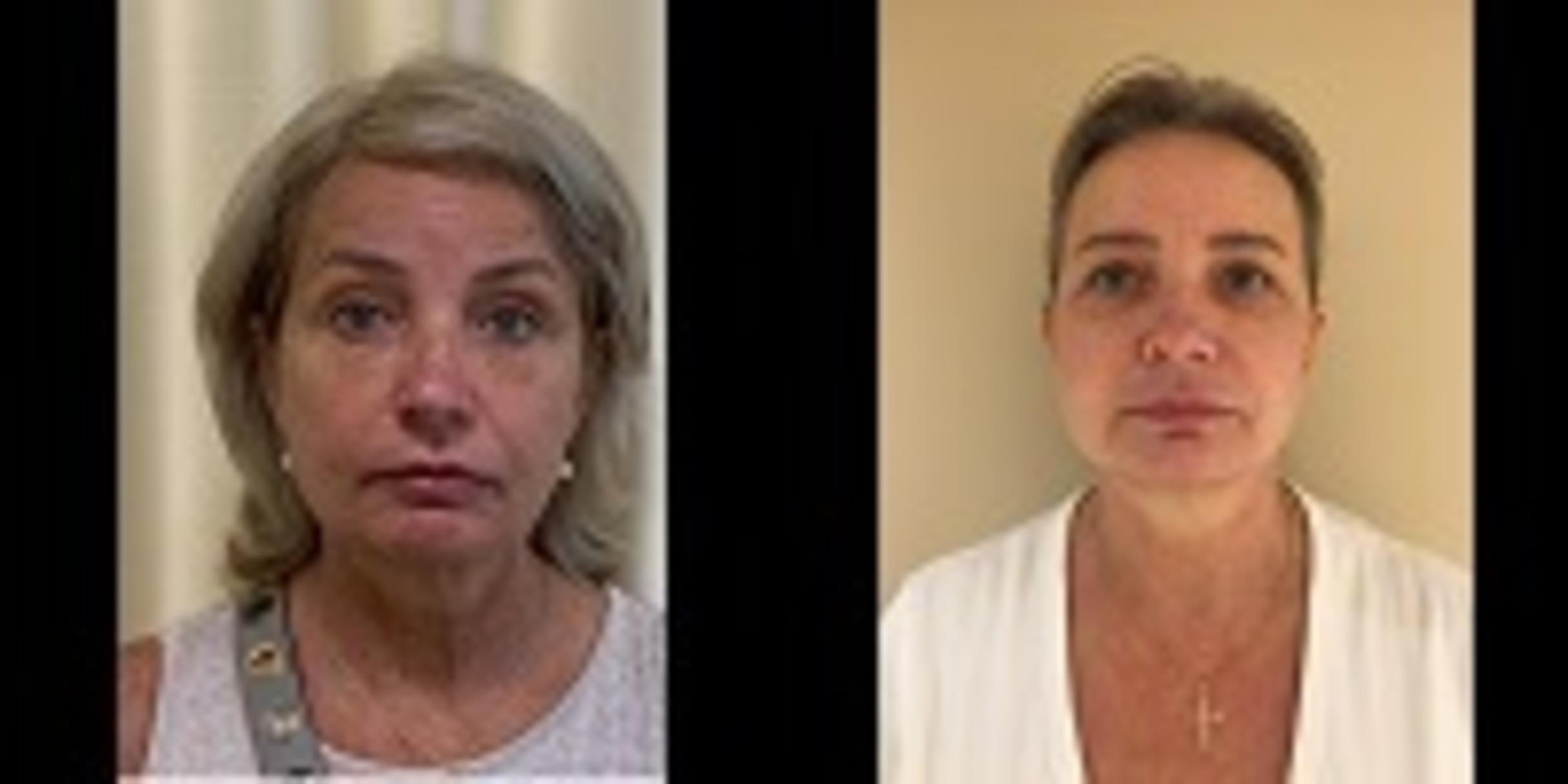 Facelift & Neck Lift Before and After Photo Gallery | Mississauga ...