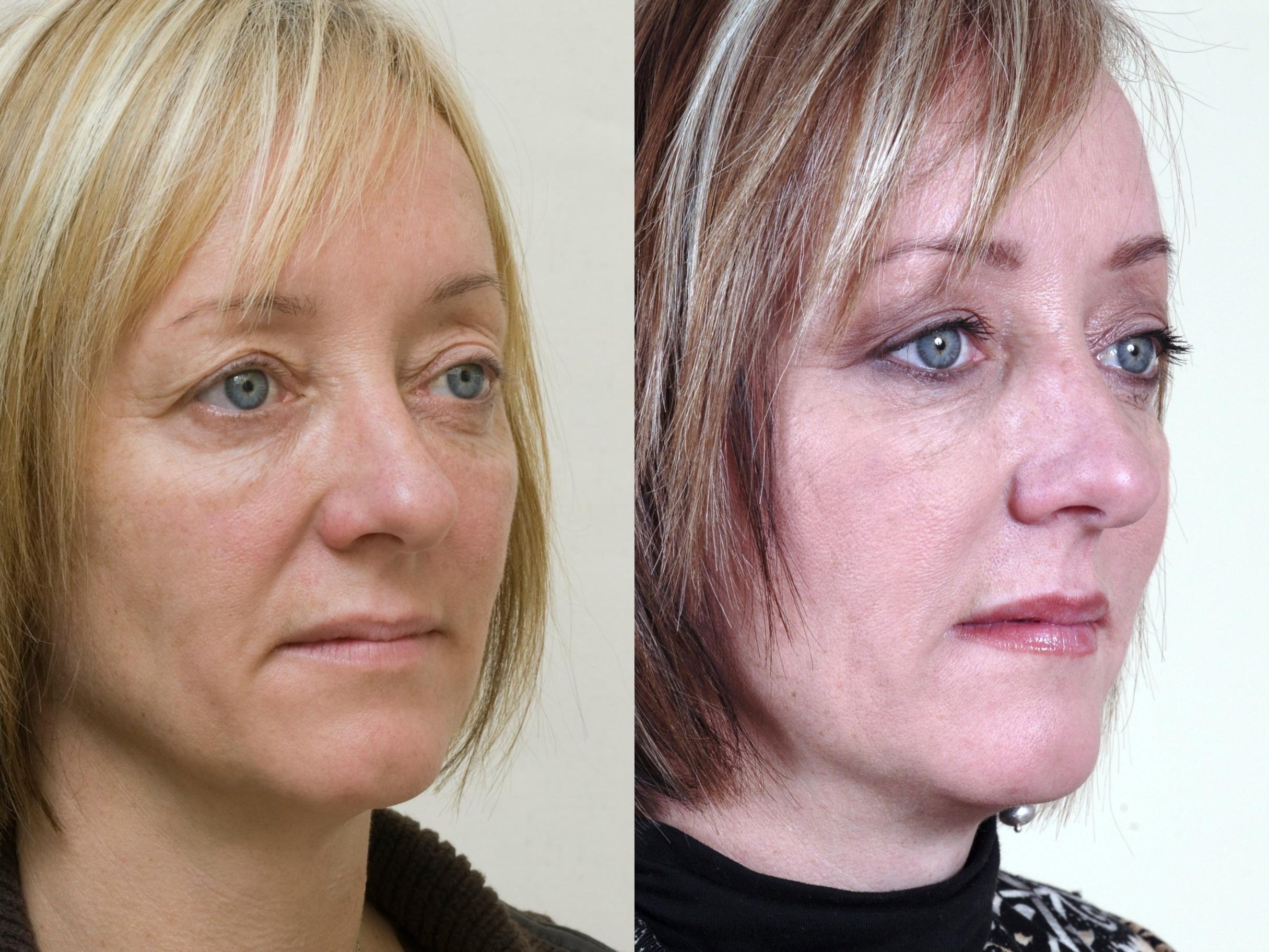 Injectable Fillers Before and After Pictures Case 42 | Mississauga ...